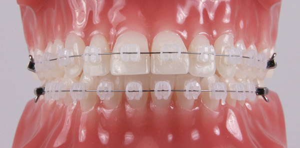 Брекет-системи ᐉ Установка брекет-систем в Києві 🦷 Astra Dent