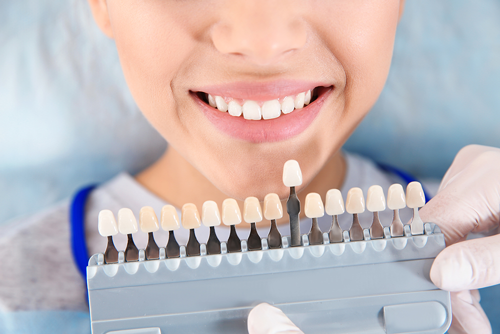 The secrets of veneers ᐉ Dentistry News from Astra Dent