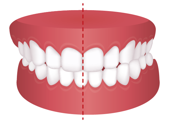 Types of bites ᐉ Dentistry News from Astra Dent