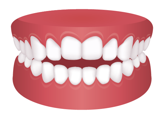 Types of bites ᐉ Dentistry News from Astra Dent