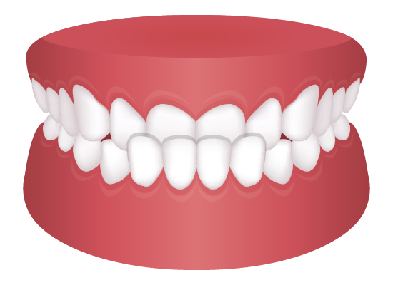 Types of bites ᐉ Dentistry News from Astra Dent